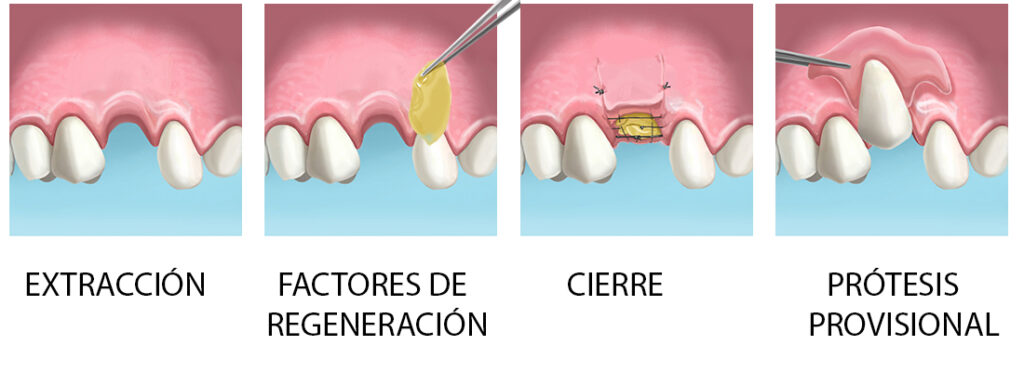 Extraccion de un diente | Fases